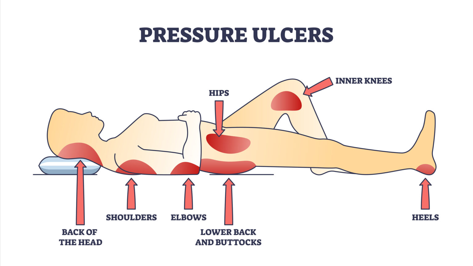 Assessing Pressure Injuries - Finch Healthcare